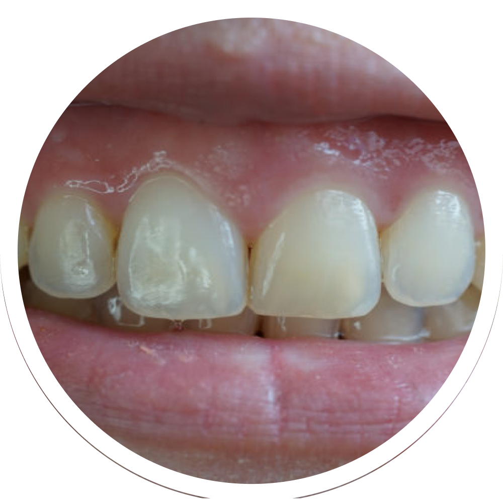 cosmetic gum surgery – Invisalign Dentist Sibu, Sarawak