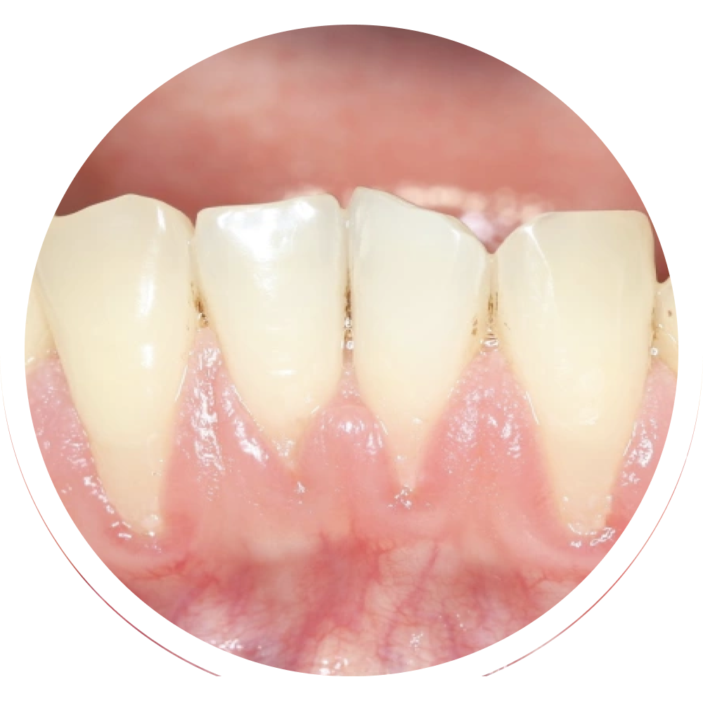 cosmetic gum surgery – Invisalign Dentist Sibu, Sarawak