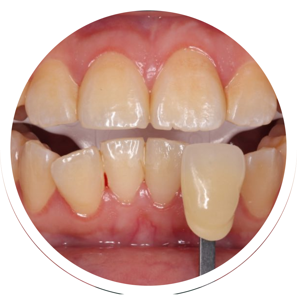 Professional Laser Teeth Whitening Treatment in Miri & Sibu, Malaysia ...