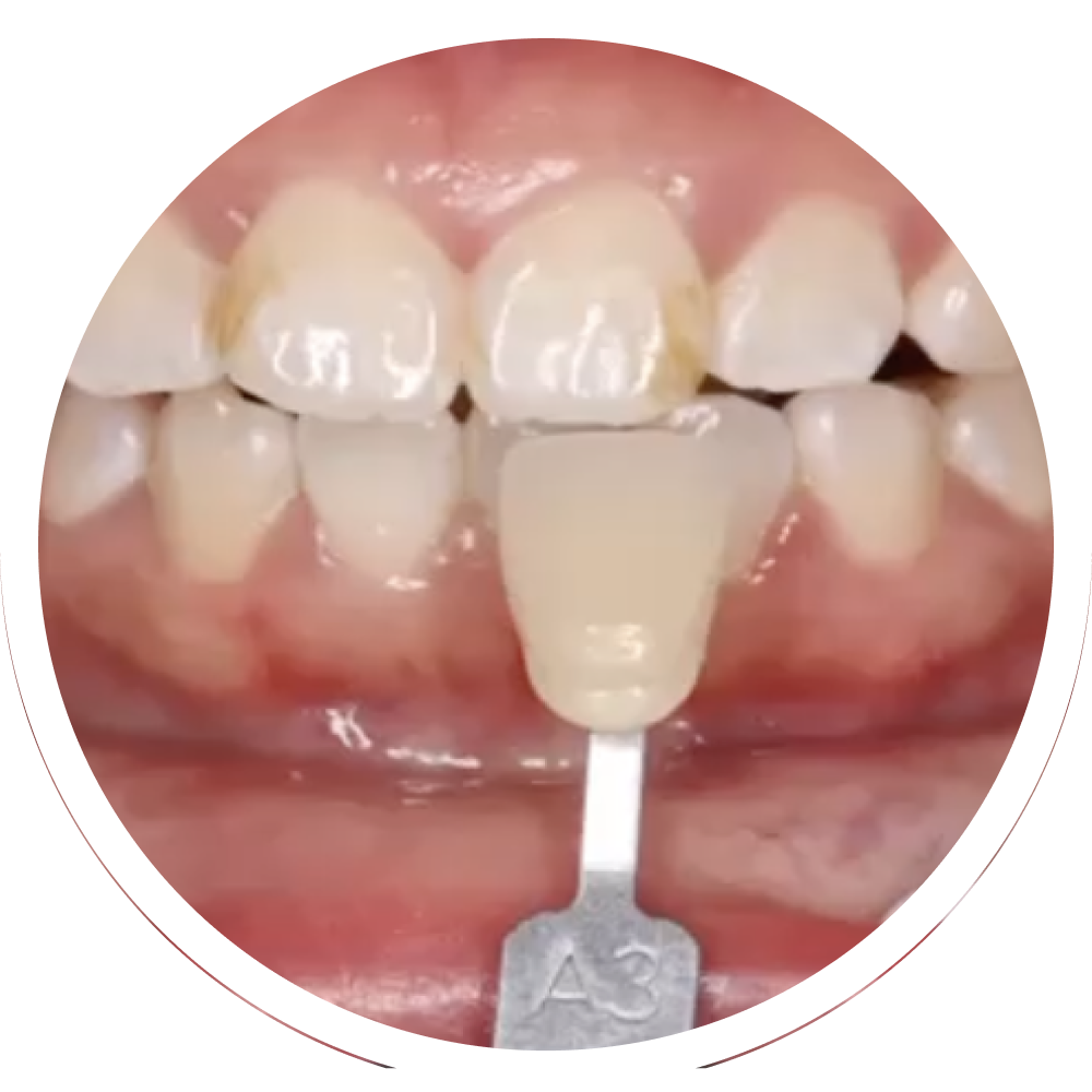 Professional Laser Teeth Whitening Treatment in Miri & Sibu, Malaysia ...