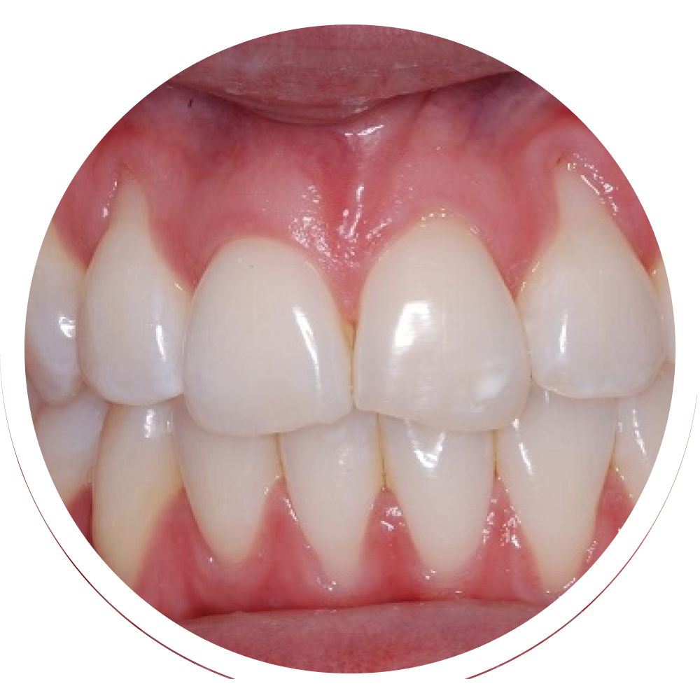 cosmetic gum surgery – Invisalign Dentist Sibu, Sarawak