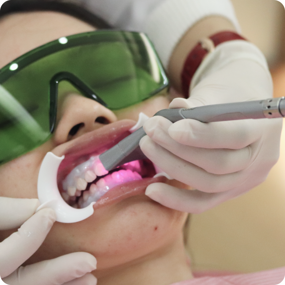 laser teeth whitening – Invisalign Dentist Sibu, Sarawak